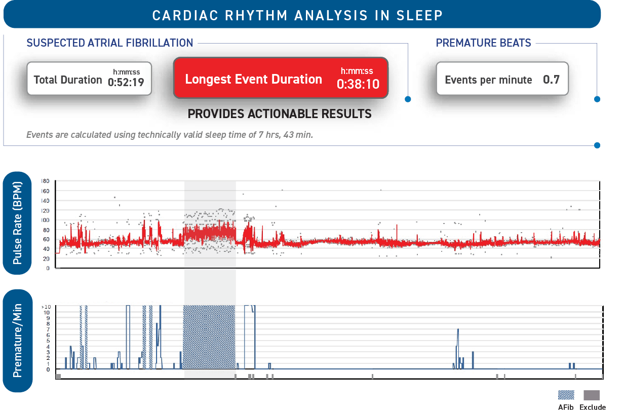 Arrhythmia Detection - ZOLL Itamar